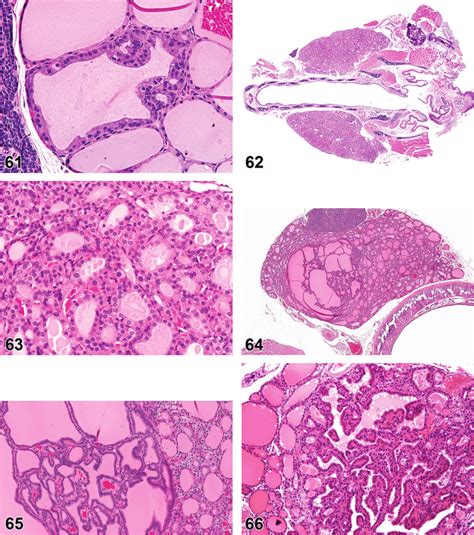 Hyperplasia Of Thyroid Gland