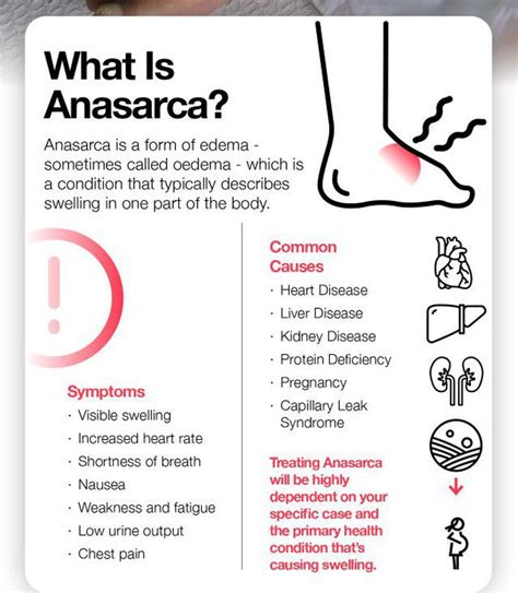 Treatment Of Anasarca Medizzy