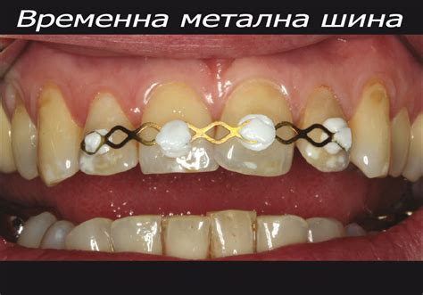 What Is Splinting Teeth At Francis Holston Blog