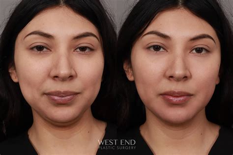Jawline Filler Juvederm Volux Before And After Gallery Case 10111