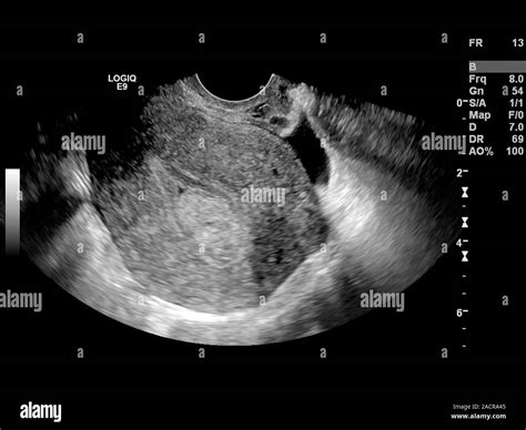 Endometrial Polyp Ultrasound Scan Photograph By Scien