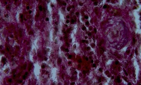 Microphotograph Of Chronic Endometritis Showing Atrophy Of Endometrial Download Scientific