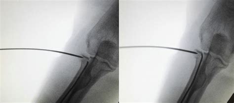 Reduction Of Fragment Assisted By Percutaneous Wire Download