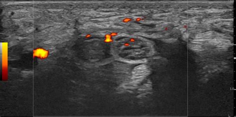 Persistent Median Artery Thrombosis With Carpal Tunnel Syndrome Sonotool®