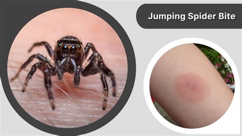 33 Types Of Spider Bites Identification Danger Levels And Pictures