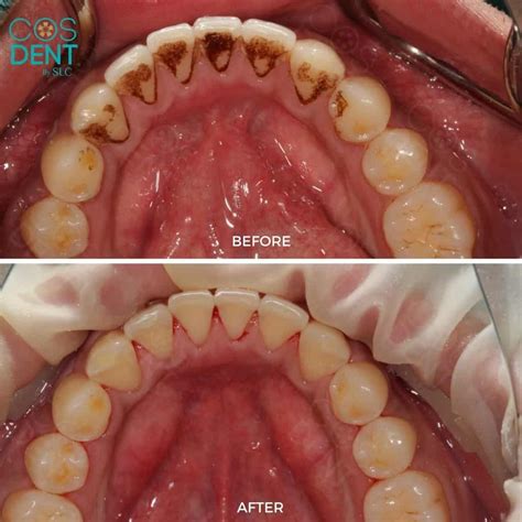 ขจัดคราบฟันเหลือง ฟันเป็นคราบดํา ใน 15 นาที ด้วย Airflow Cosdent