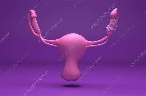 Ovarian Cancer Illustration Stock Image F0438346 Science Photo Library