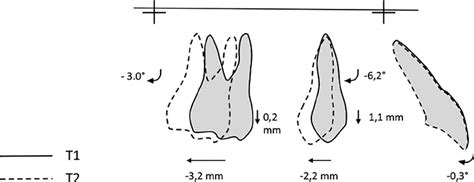 Graphic Representation Of Maxillary Superimposition For Distal Screw