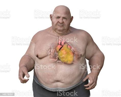 과체중 남자의 뚱뚱한 심장 3d 그림 비만과 내부 장기 질환의 개념 의사에 대한 스톡 사진 및 기타 이미지 의사 3차원 형태 개념 Istock