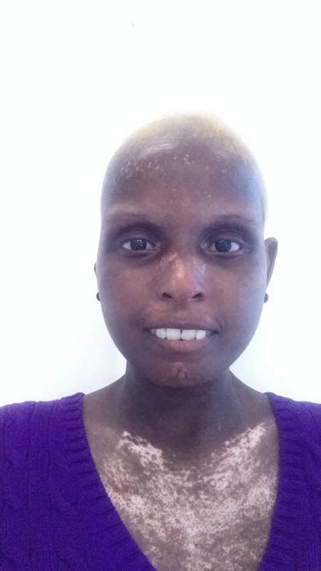 Systemic Scleroderma Face