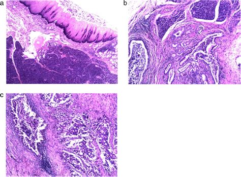 A Ectopic Pancreas With Lobular Structure Highlighted In The Download Scientific Diagram