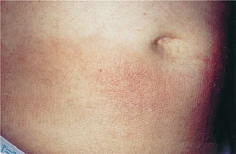 Case 2 Erythematous Macular Download Scientific Diagram