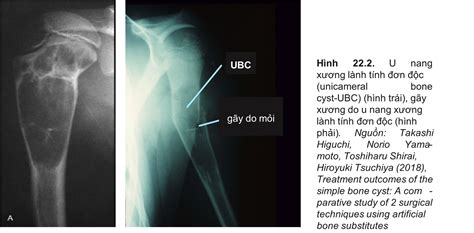 B I Gi Ng G Y X Ng B Nh L Kh Ng Do Nguy N Nh N C T Nh C P Nh T Pgs Ts Bs V Th Nh To N