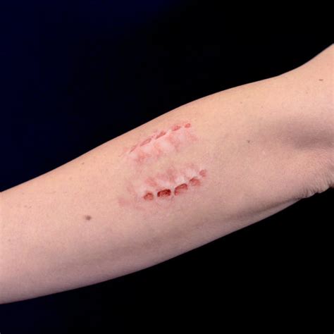 Bite Marks Out Of Kit