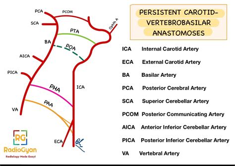 Persistent Trigeminal Artery Radiology Case