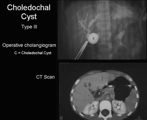 Ultrasound Classification Of Choledochal Cyst