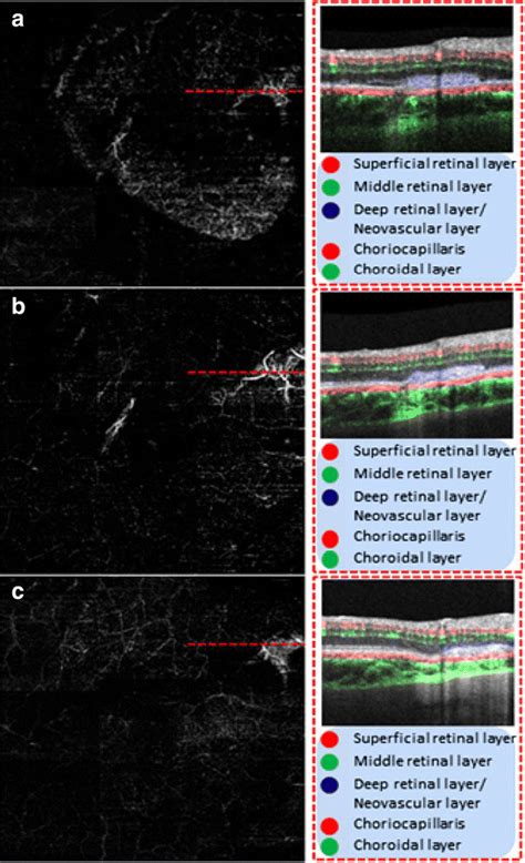 Oct At The Level Of The Choroidal Rupture With Concern For Cnvm Shown Download Scientific