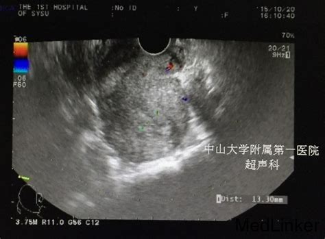 双侧输卵管阻塞 医联