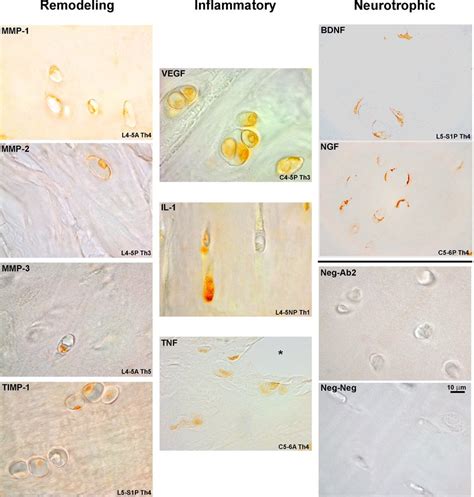 Ihc Staining G1 Specimens Disc Region And Thompson Grade Th Download Scientific Diagram