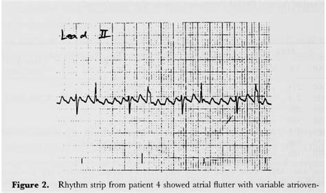 Figure 1 From Atrial Flutter In The Neonate And Early Infancy