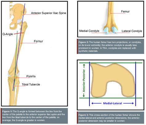 De Gendering The Knee Overemphasizing Sex Differences As A Problem Gendered Innovations