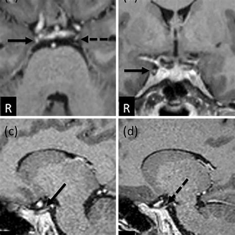 Figure2gadolinium Enhanced T1 Weighted Magnetic Resonance Imaging