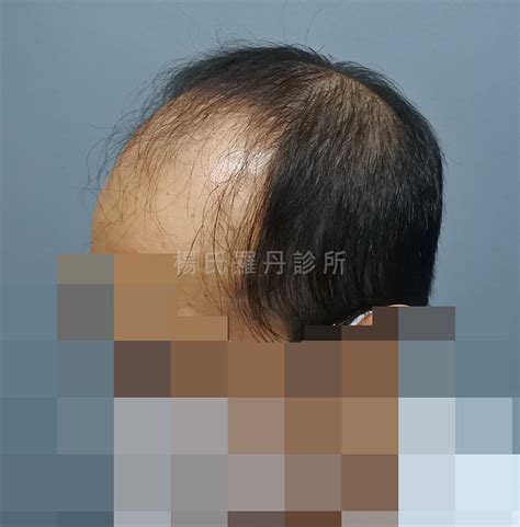 【植髮】植得改變的選擇，楊氏羅丹完美解決禿頭難題！ 案例分享artas植髮