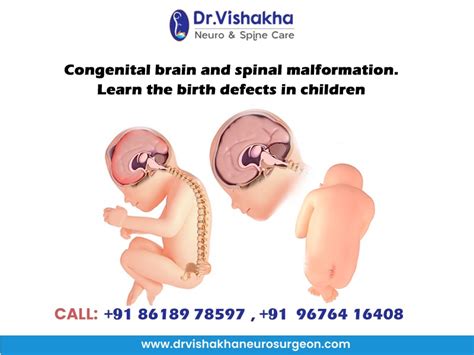 Congenital Brain And Spinal Malformation Learn The Birth Defects In