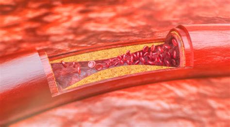 10 500 Aterosklerosis Foto Stok Potret And Gambar Bebas Royalti Istock