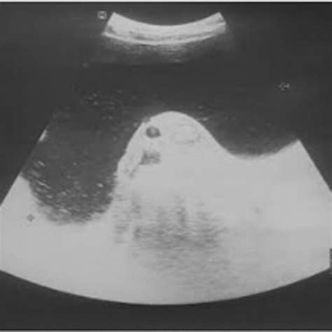 Radical Vulvectomy And Repair With Lymph Node Dissection A Anatomy Download Scientific