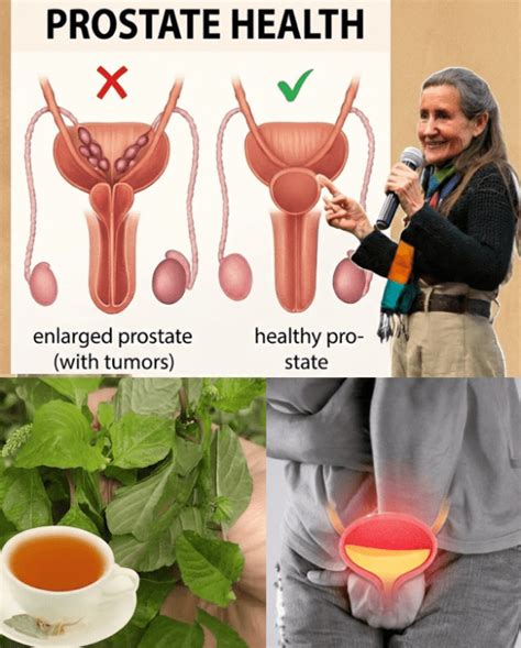 The Best Herbs To Treat Enlarged Prostate Bph Natures Hidden