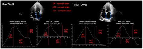 Automated Detection Of Severe Aortic Stenosis Using 40 Off