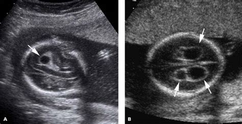 Chromosomal Anomalies Radiology Key