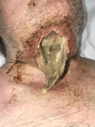 Submandibular Abscess With Orocutaneous Fistula With Visualized
