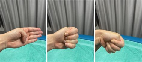 De Quervains Tenosynovitis Quay Health
