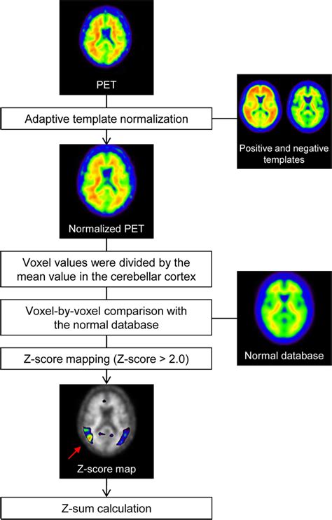The Workflow Of The Voxel Based Statistical Analysis Download