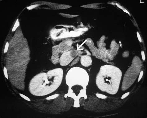 Figure 1 From Leiomyosarcoma Of The Inferior Vena Cava Involving The Renal Veins A Simple