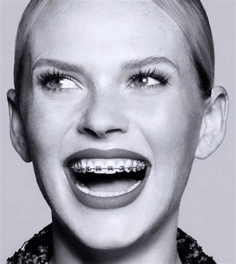 Braces Keep Em Clean Keep Em Keen 🦷 Follow These Simple Steps For