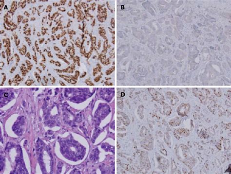 Figure 1 From Sentinel Lymph Node Mapping Of A Breast Cancer Of The