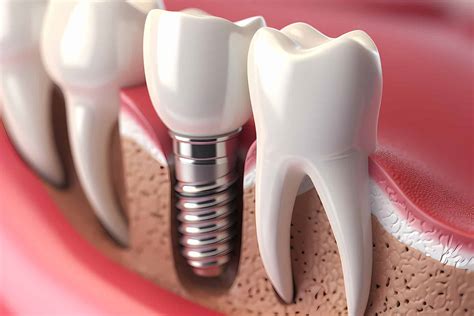 Single Tooth Implant Dentistry In Tucson Tooth Replacement