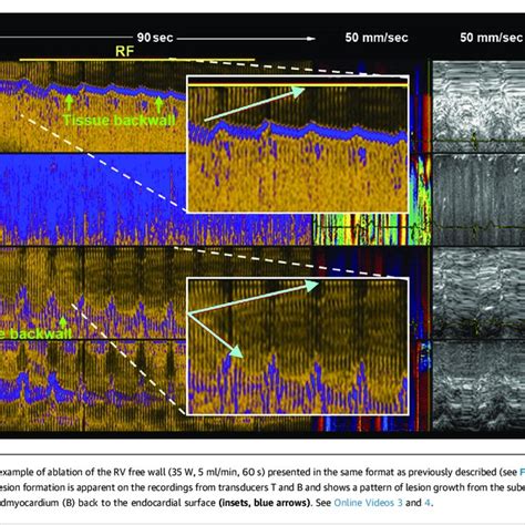 Rf Lesion Formation In The Right Ventricle Download Scientific Diagram