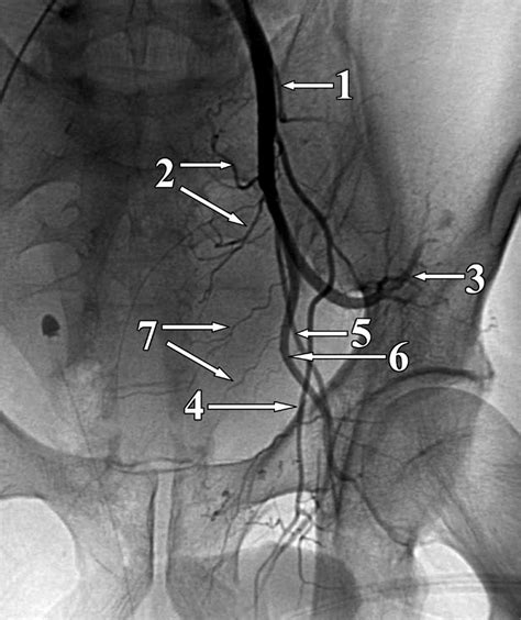 Female Internal Iliac Artery Branches Posterior Divis