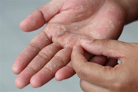 Understanding Eczema Definition Symptoms Causes And Treatments