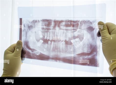 Panoramic Jaw X Ray At Melody Hanks Blog