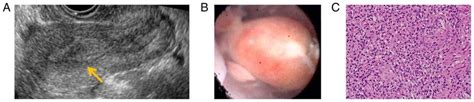 Low Grade Endometrial Stromal Sarcoma In A Young Woman Diagnosed After Resection Of Endometrial
