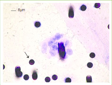 Circulating Tumor Microembolus Ctm F Rom Undifferentiated
