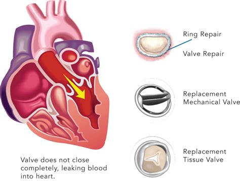 Heart Valve Surgery Cvskl