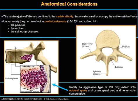 Vertebral Hemangioma Surgical Management Of Symptomatic T8 Vertebral