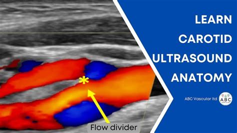 Carotid Artery Doppler Ultrasound Test Accurate Examination To Perform