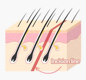 Hidden Scar Forehead Reduction ONYOO Plastic Surgery